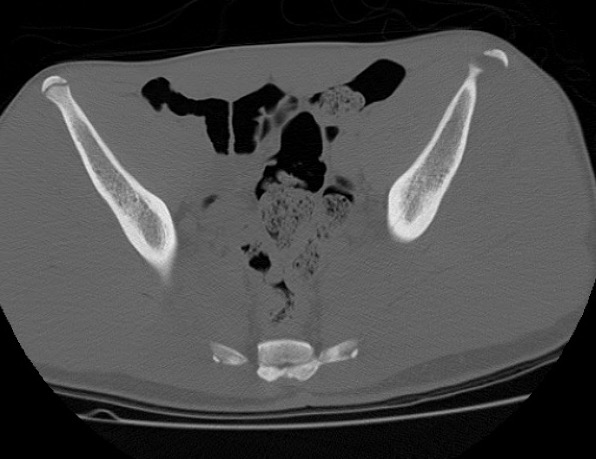 Apophyseal Avulsions | The Bone School